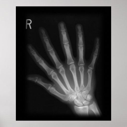 Radiografía de mano derecha - Imagui Radiografía de mano derecha - Imagui